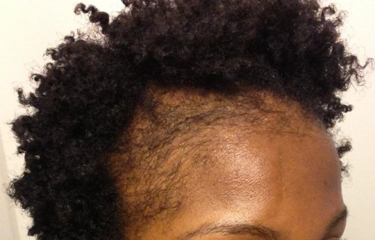 How To Regrow And Protect Your Edges – Organic Beauty Essence